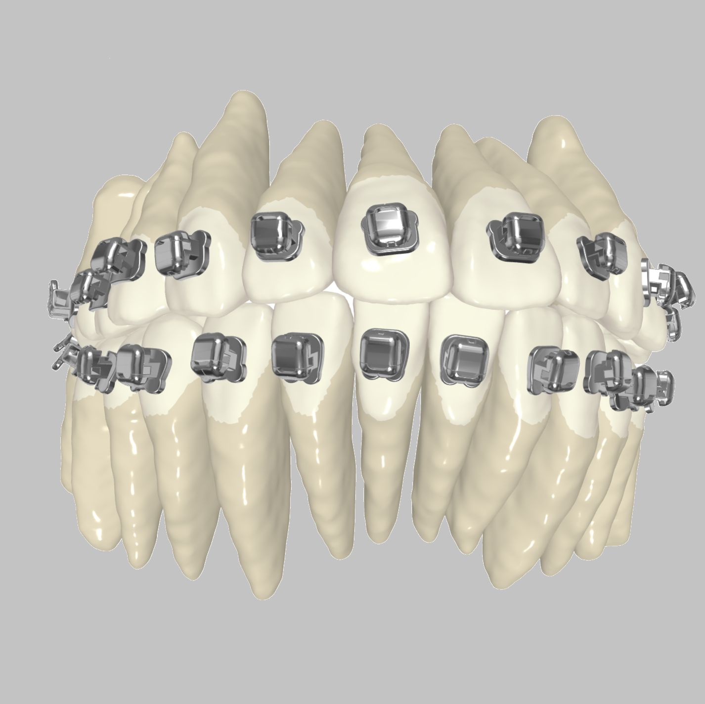 Custom Braces - as easy as clear aligners! – Dental Mates