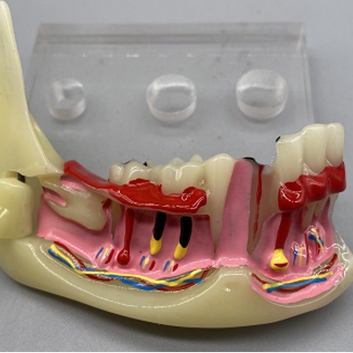Mandibular Pathological Model – Dental Mates